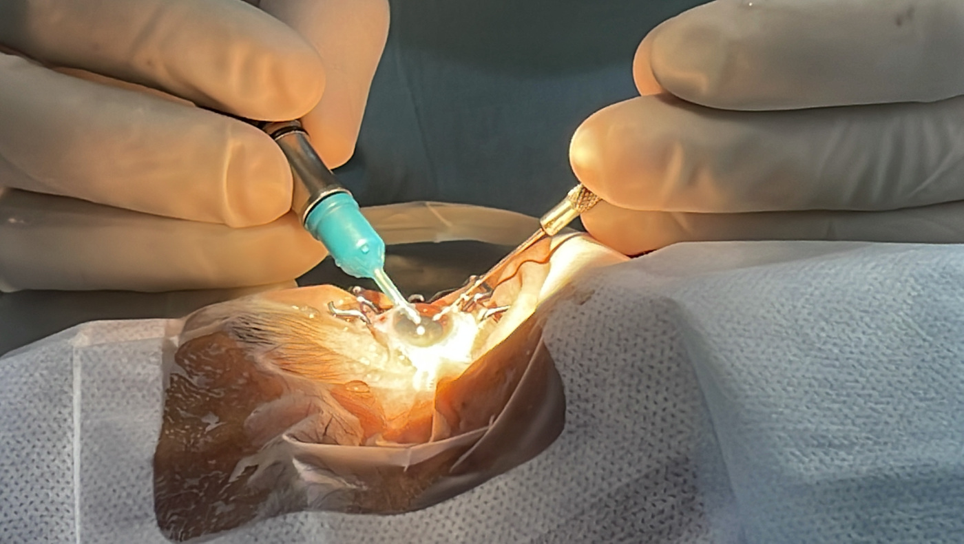 Cataract Surgery - Eye First Super Speciality Eye Centre